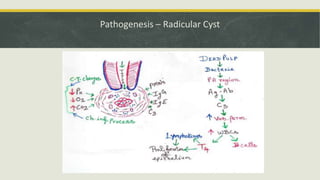 Odontogenic cyst | PPTX