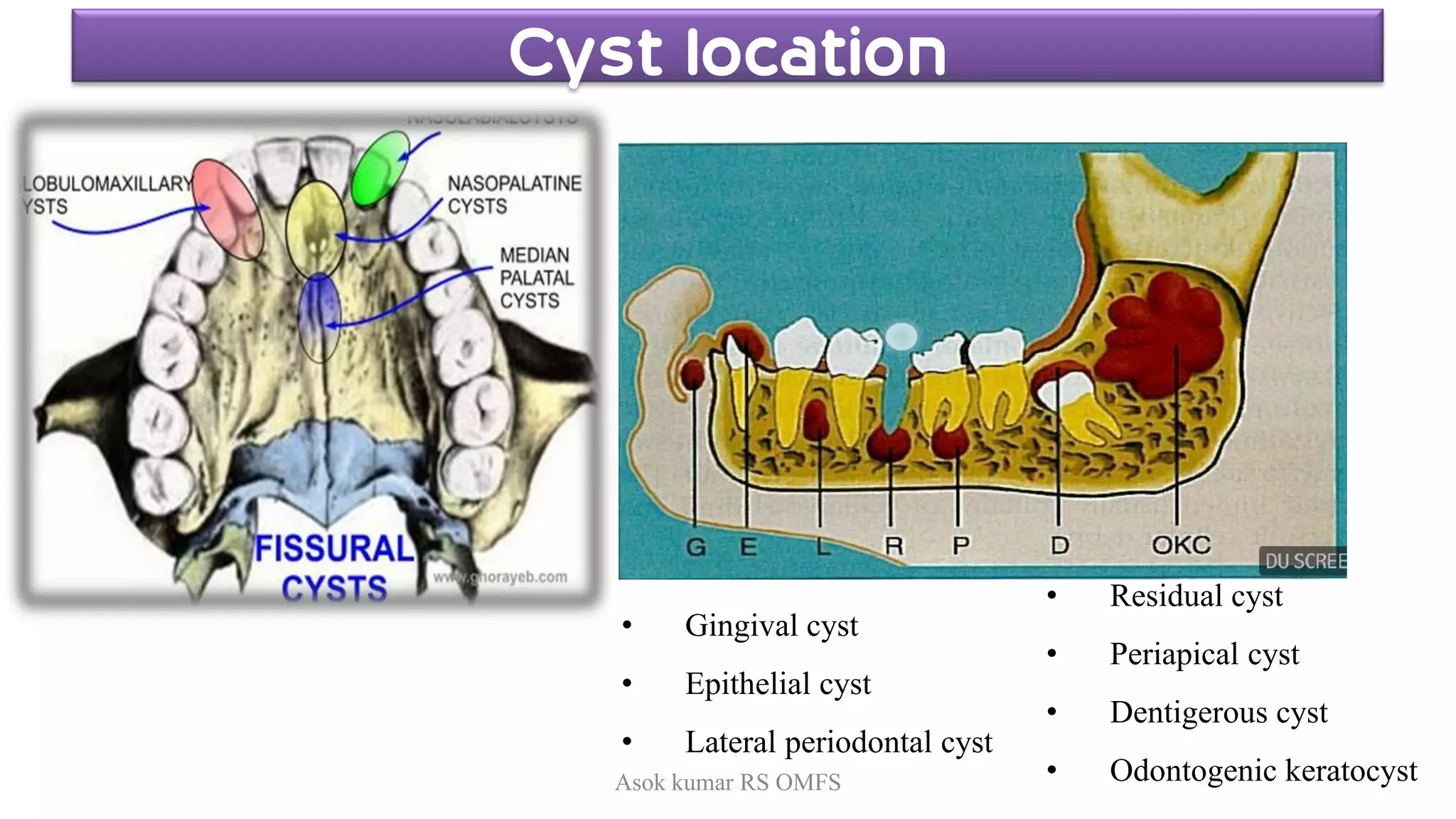 Odontogenic cyst | PDF