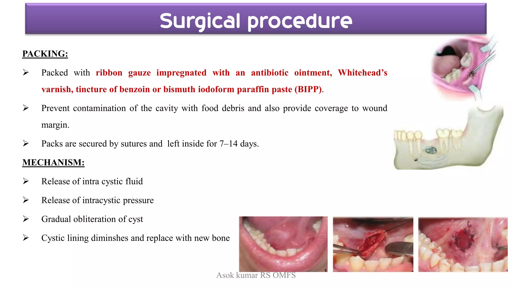 Odontogenic cyst | PDF