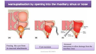 Odontogenic cyst | PDF