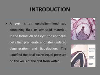 Odontogeniccysts OKC | PPTX