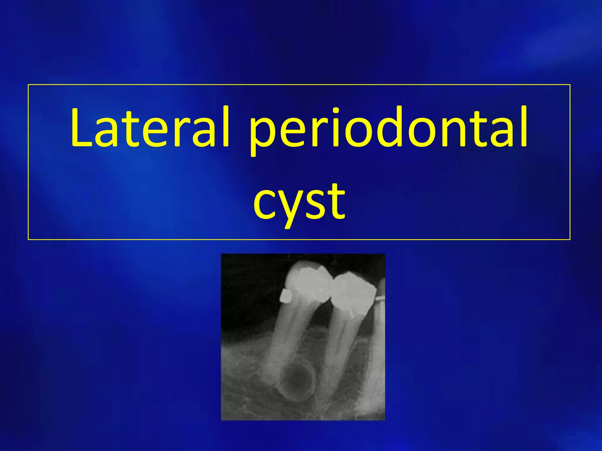 Odontogenic cysts | PPTX