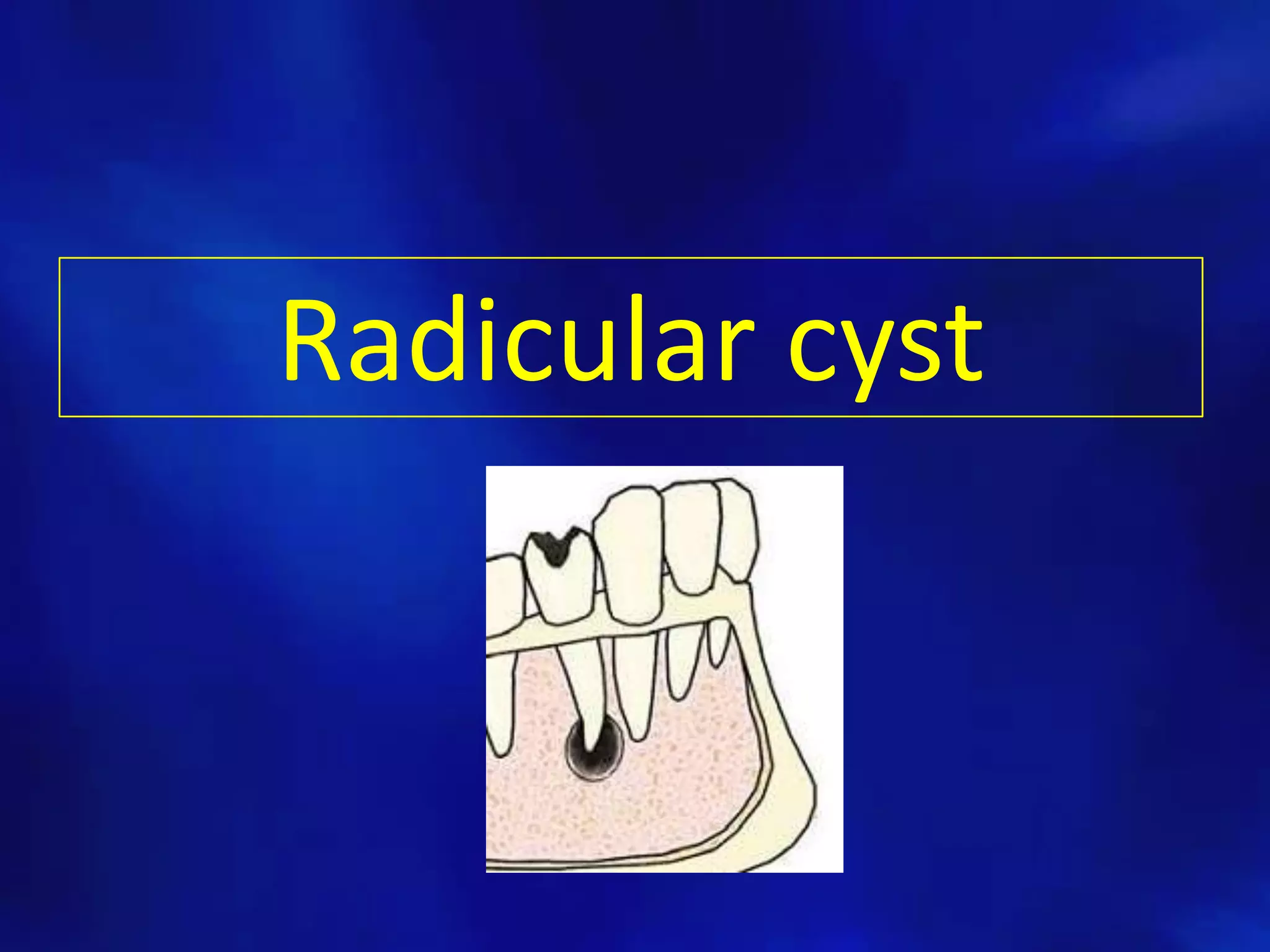 Odontogenic cysts | PPTX