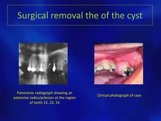 Odontogenic cysts | PPTX