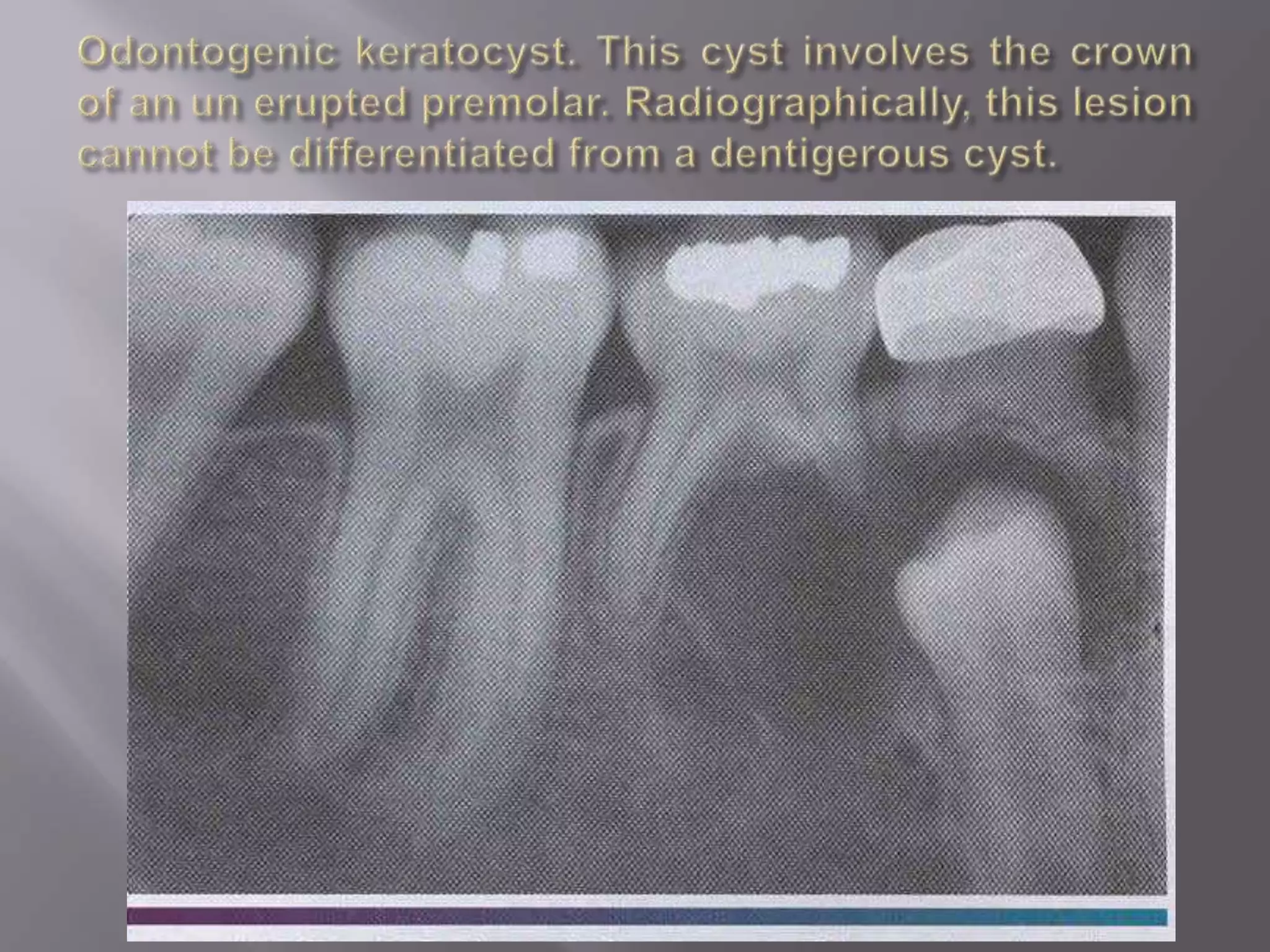 Odontogenic cysts | PPTX | Dental Health | Diseases and Conditions
