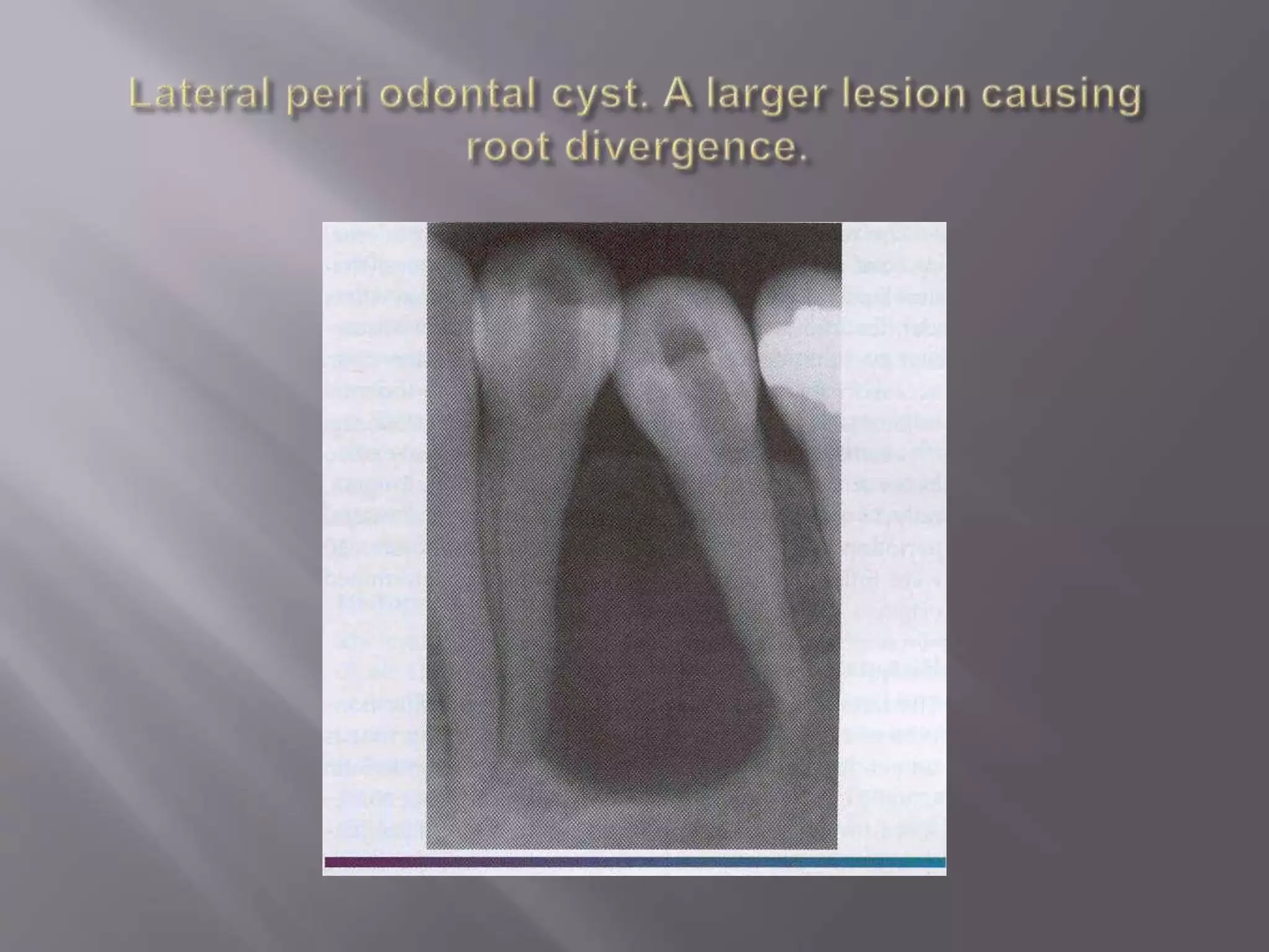Odontogenic cysts | PPTX | Dental Health | Diseases and Conditions