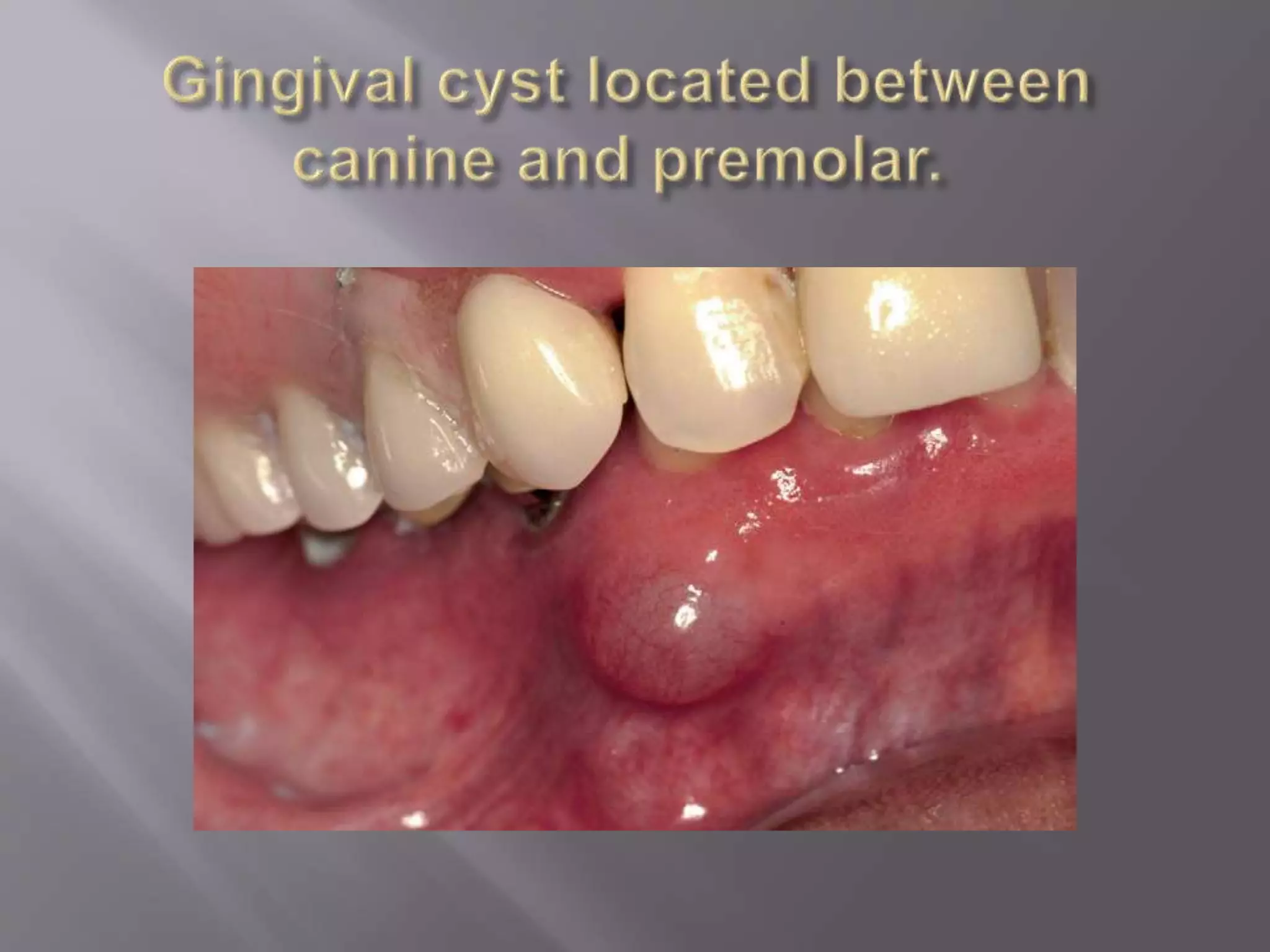 Odontogenic cysts | PPTX | Dental Health | Diseases and Conditions
