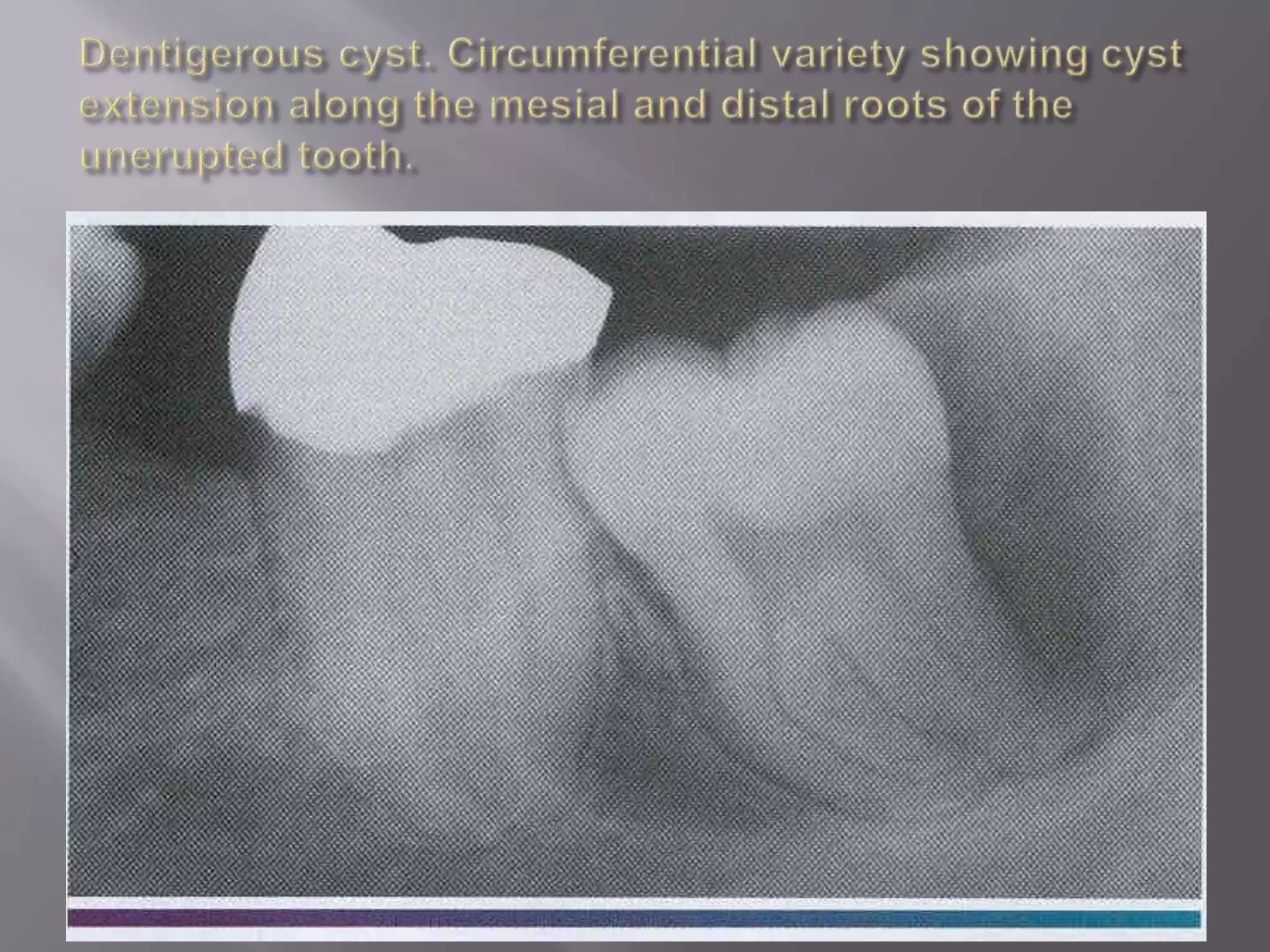 Odontogenic cysts | PPTX | Dental Health | Diseases and Conditions