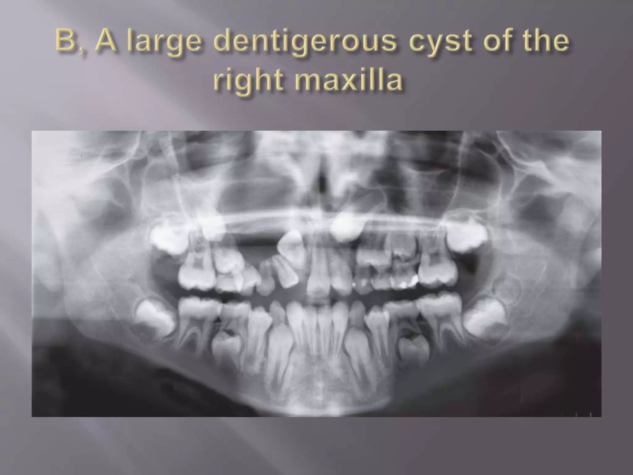 Odontogenic cysts | PPTX | Dental Health | Diseases and Conditions