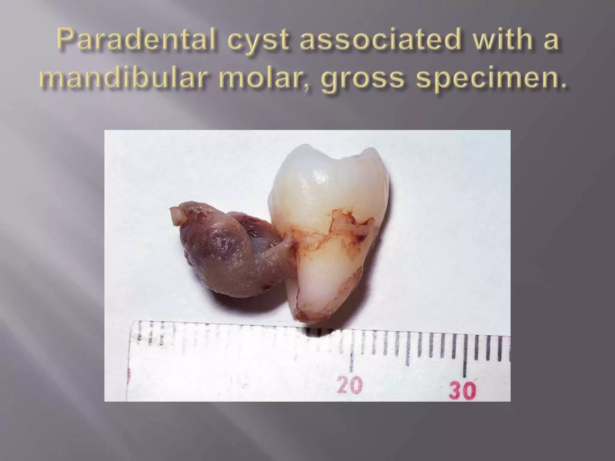 Odontogenic cysts | PPTX | Dental Health | Diseases and Conditions