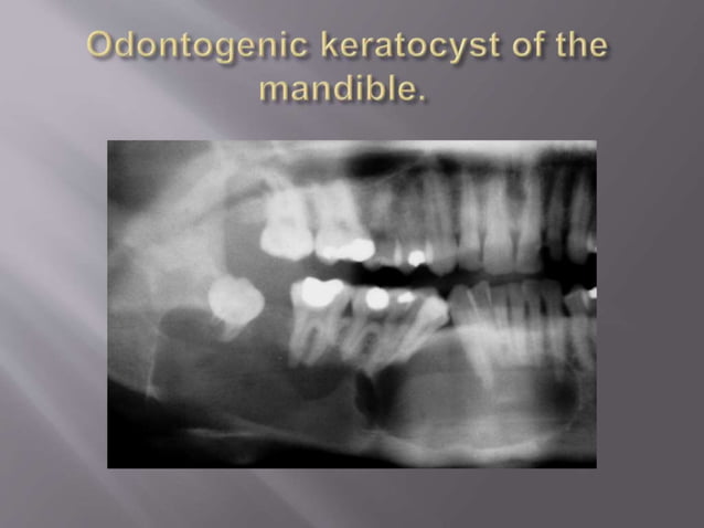 Odontogenic cysts | PPTX | Dental Health | Diseases and Conditions