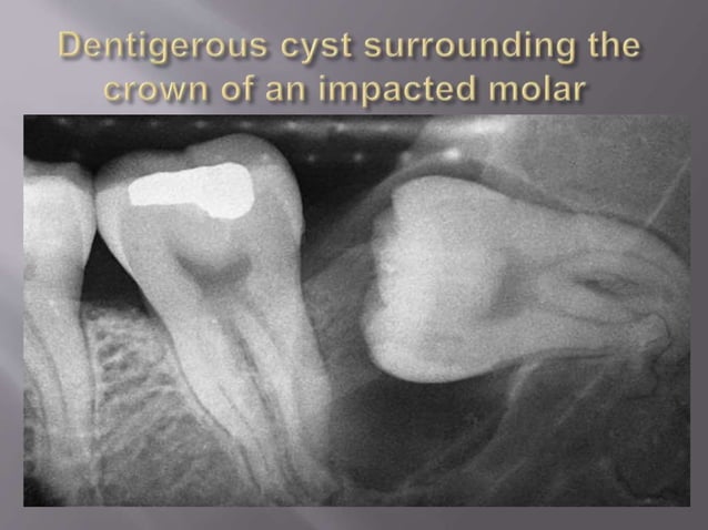 Odontogenic cysts | PPTX | Dental Health | Diseases and Conditions