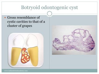 Botryoid Odontogenic Cyst
