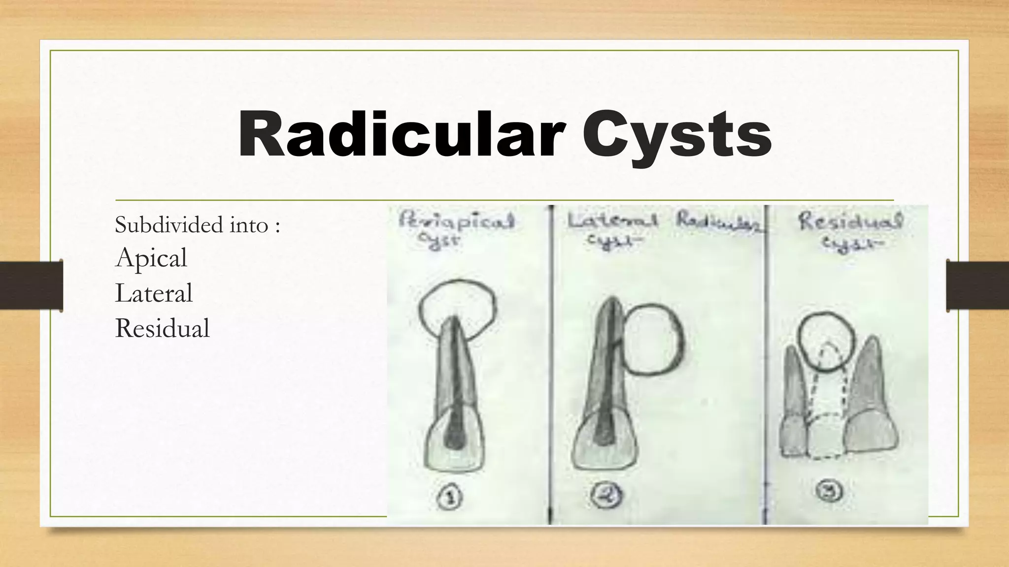 Odontogenic cyst | PPTX