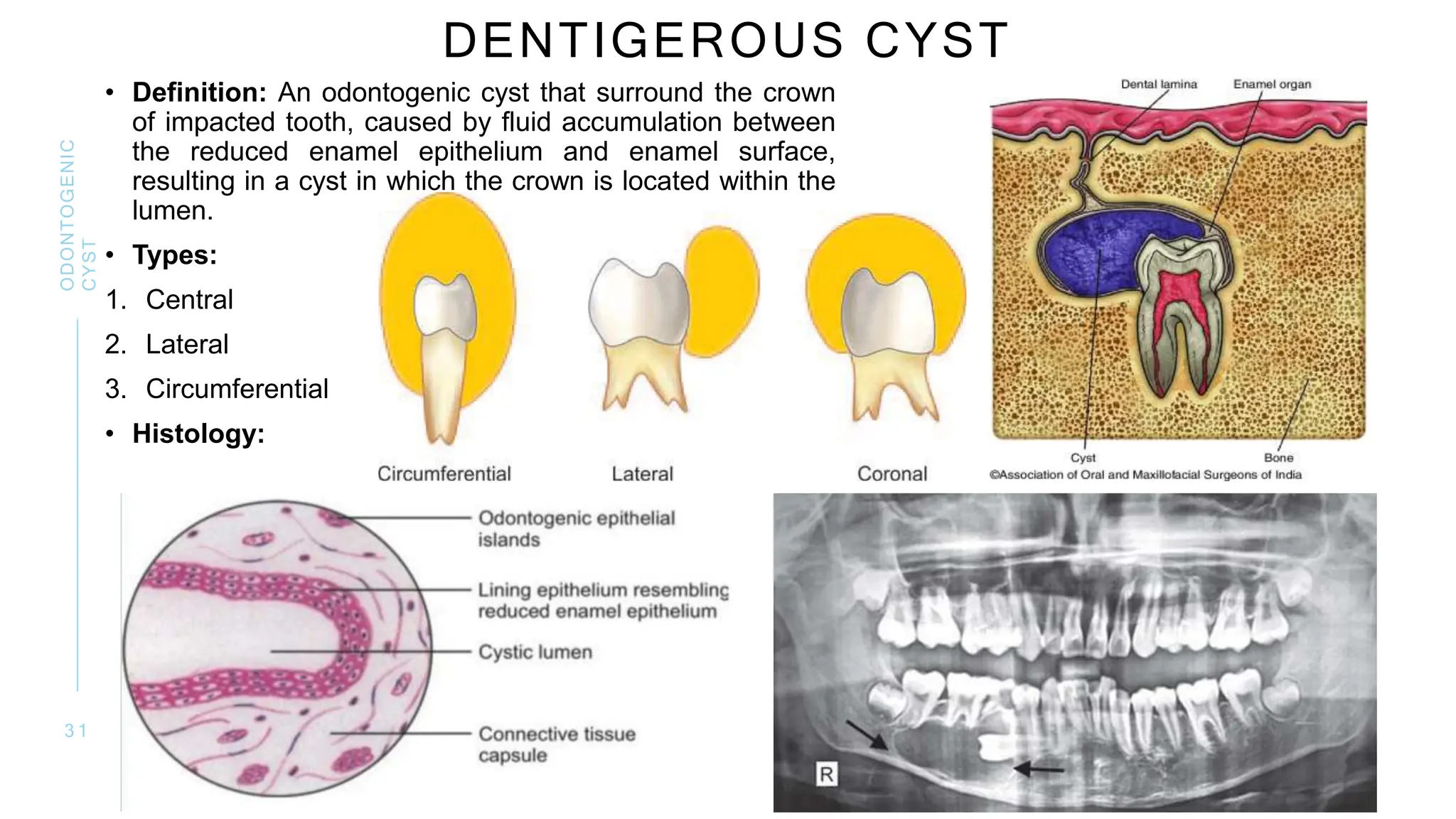 ODONTOGENIC CYSTS OF THE JAWS AND THE MANAGEMENT | PPTX