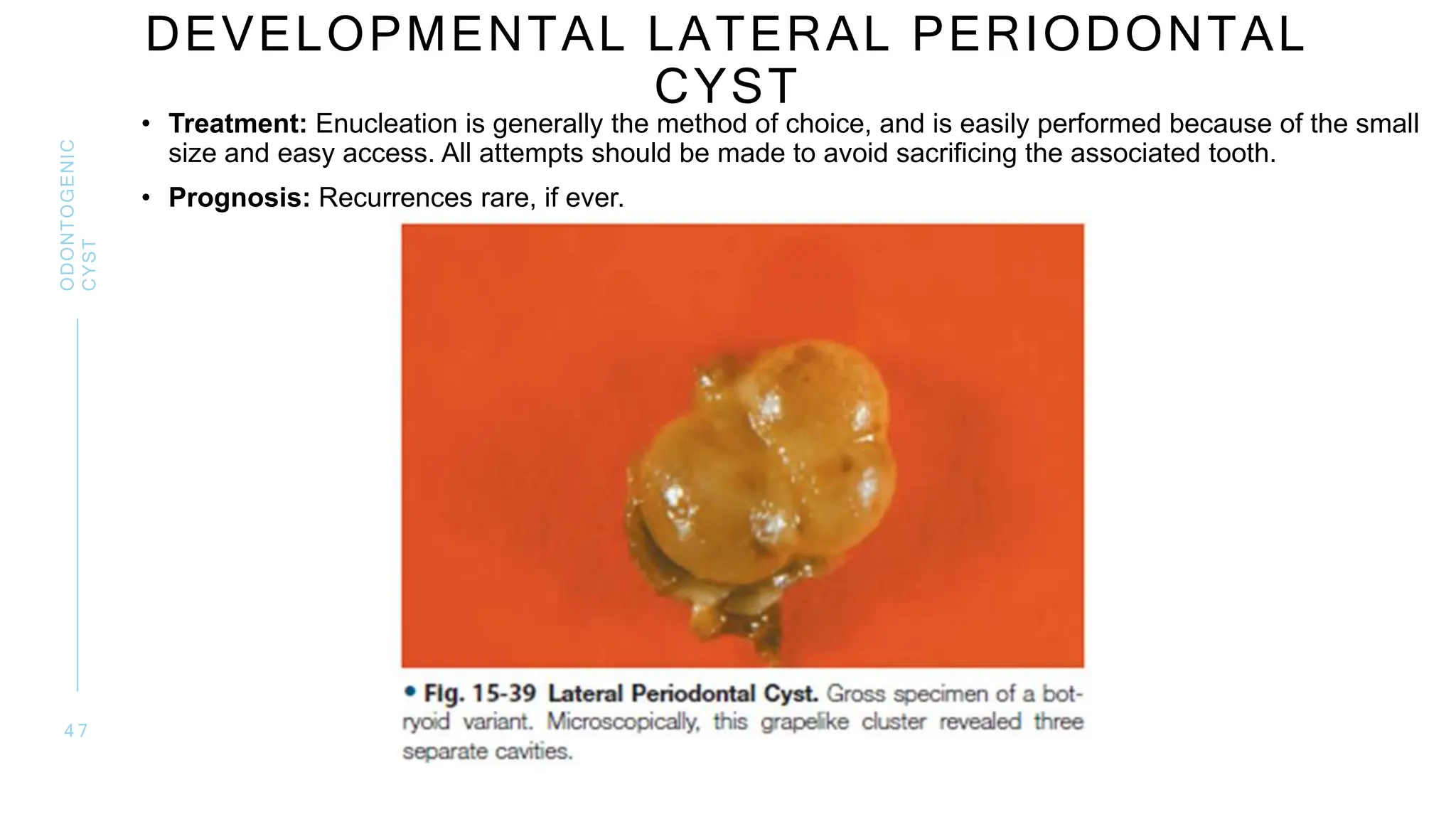ODONTOGENIC CYSTS OF THE JAWS AND THE MANAGEMENT | PPTX