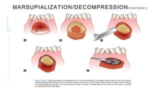 ODONTOGENIC CYSTS OF THE JAWS AND THE MANAGEMENT | PPTX