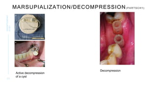 ODONTOGENIC CYSTS OF THE JAWS AND THE MANAGEMENT | PPTX