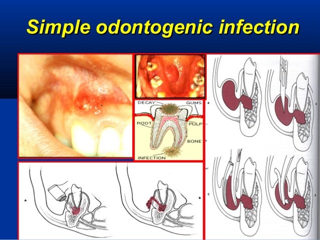 Odontogenic Infection
