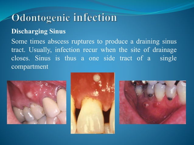 Odontogenic Infection