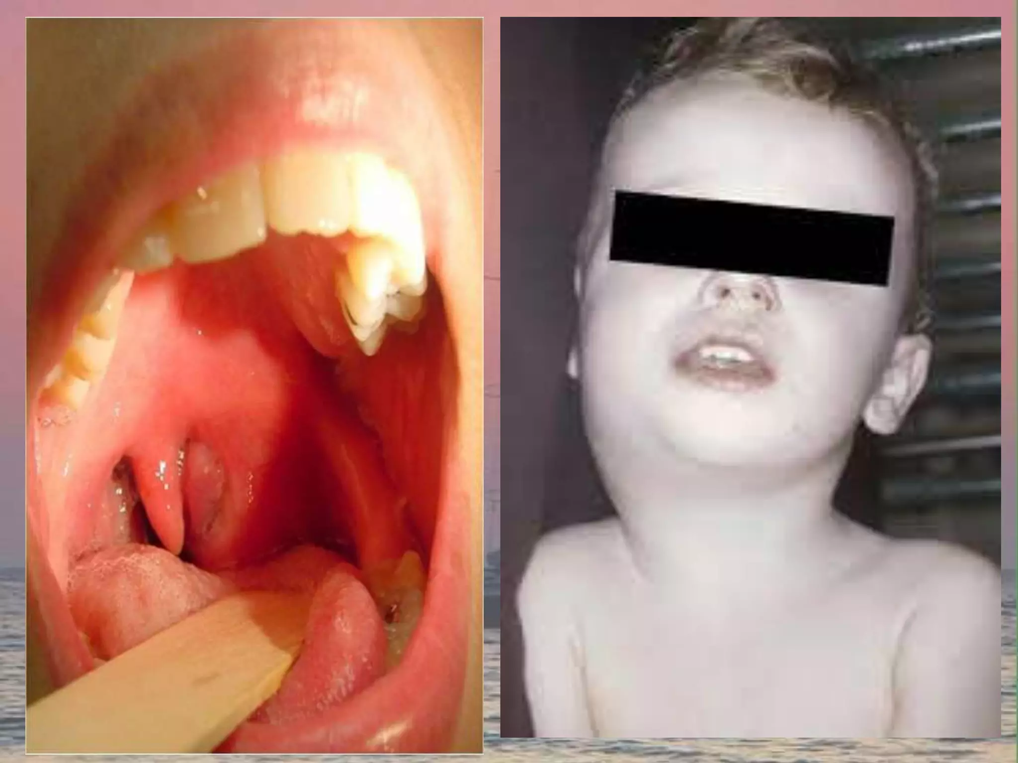 Odontogenic infection | PPSX