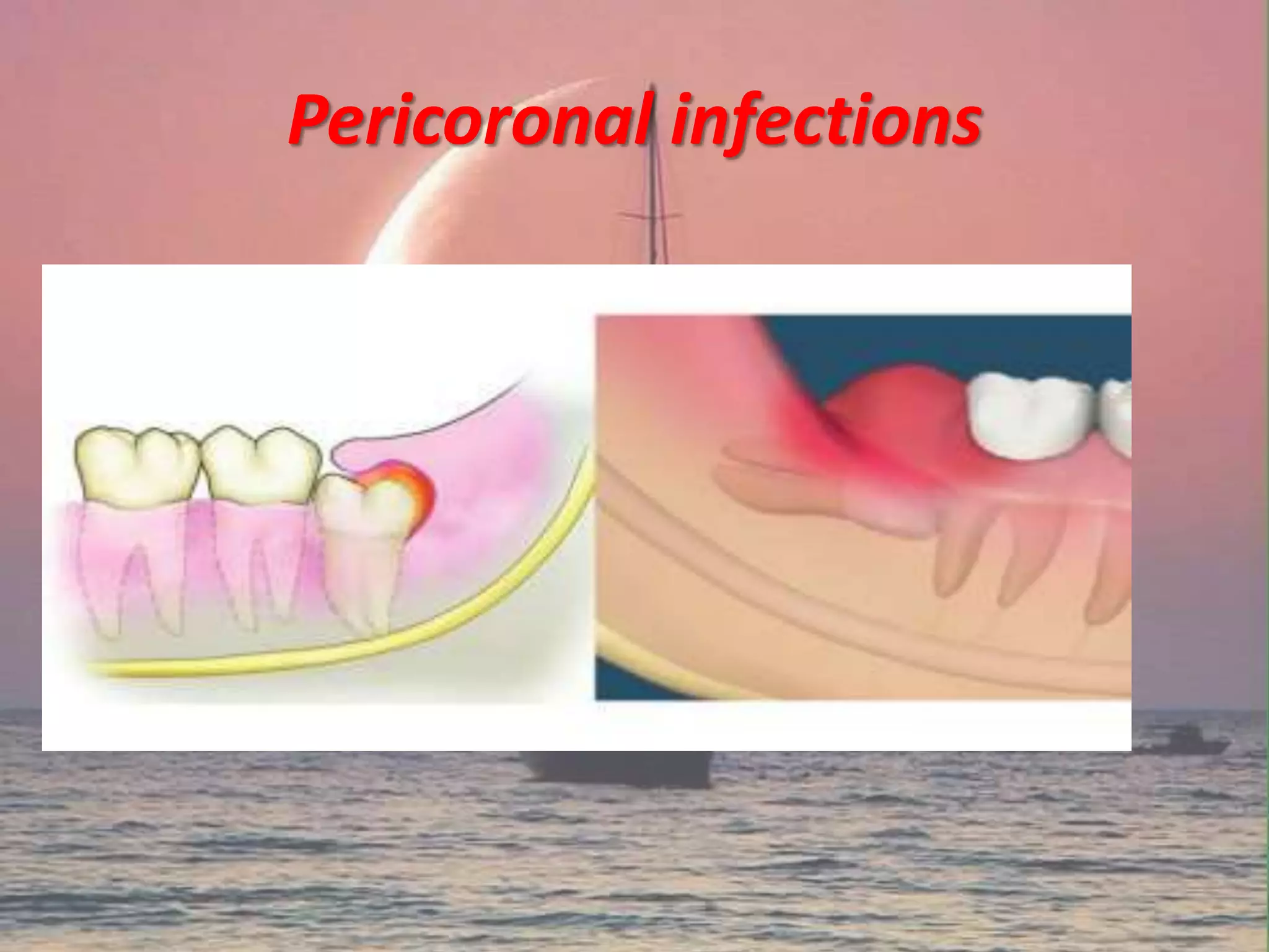 Odontogenic infection | PPSX
