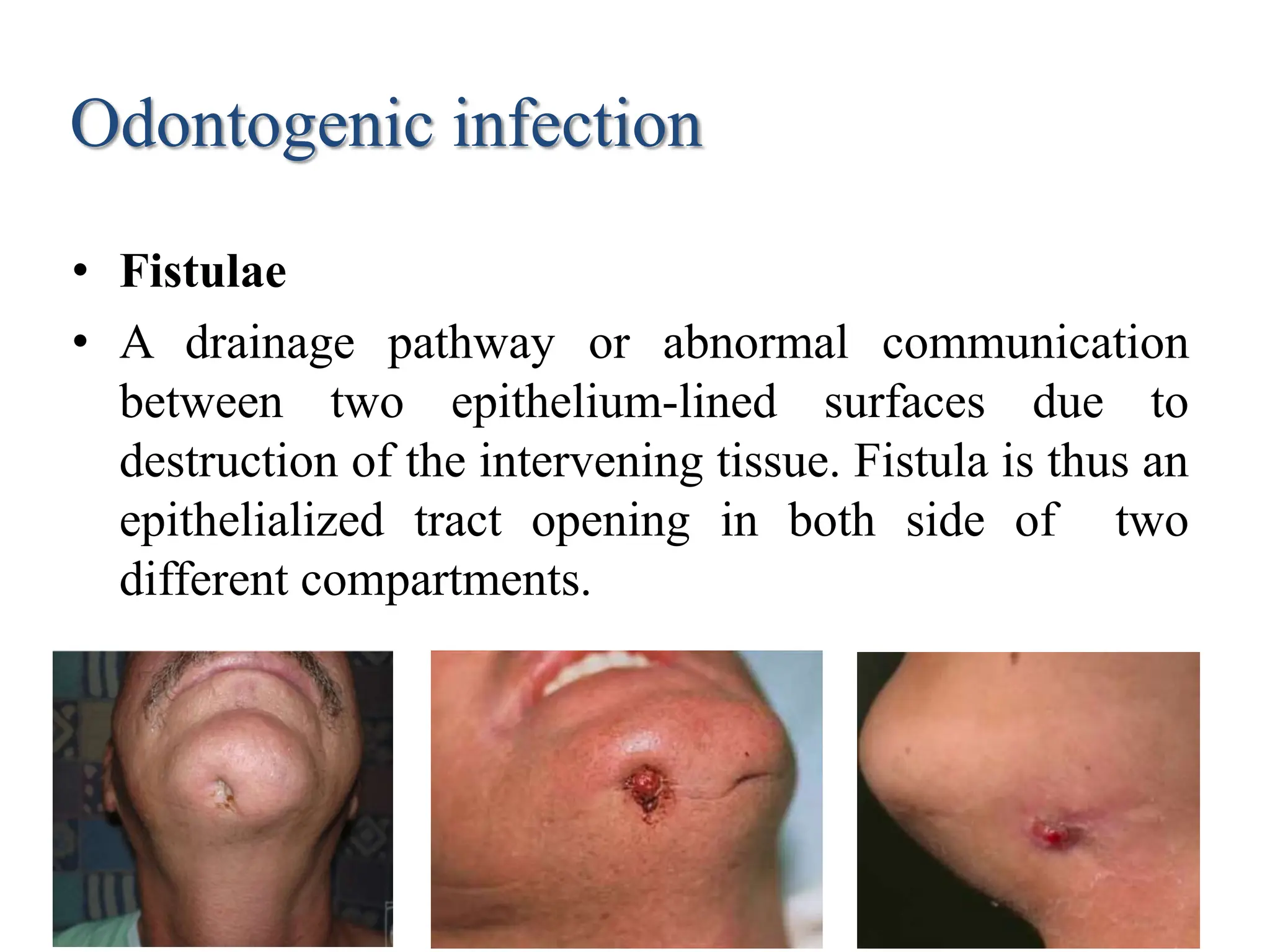 odontogenicinfections-1 in dental surgery.pptx