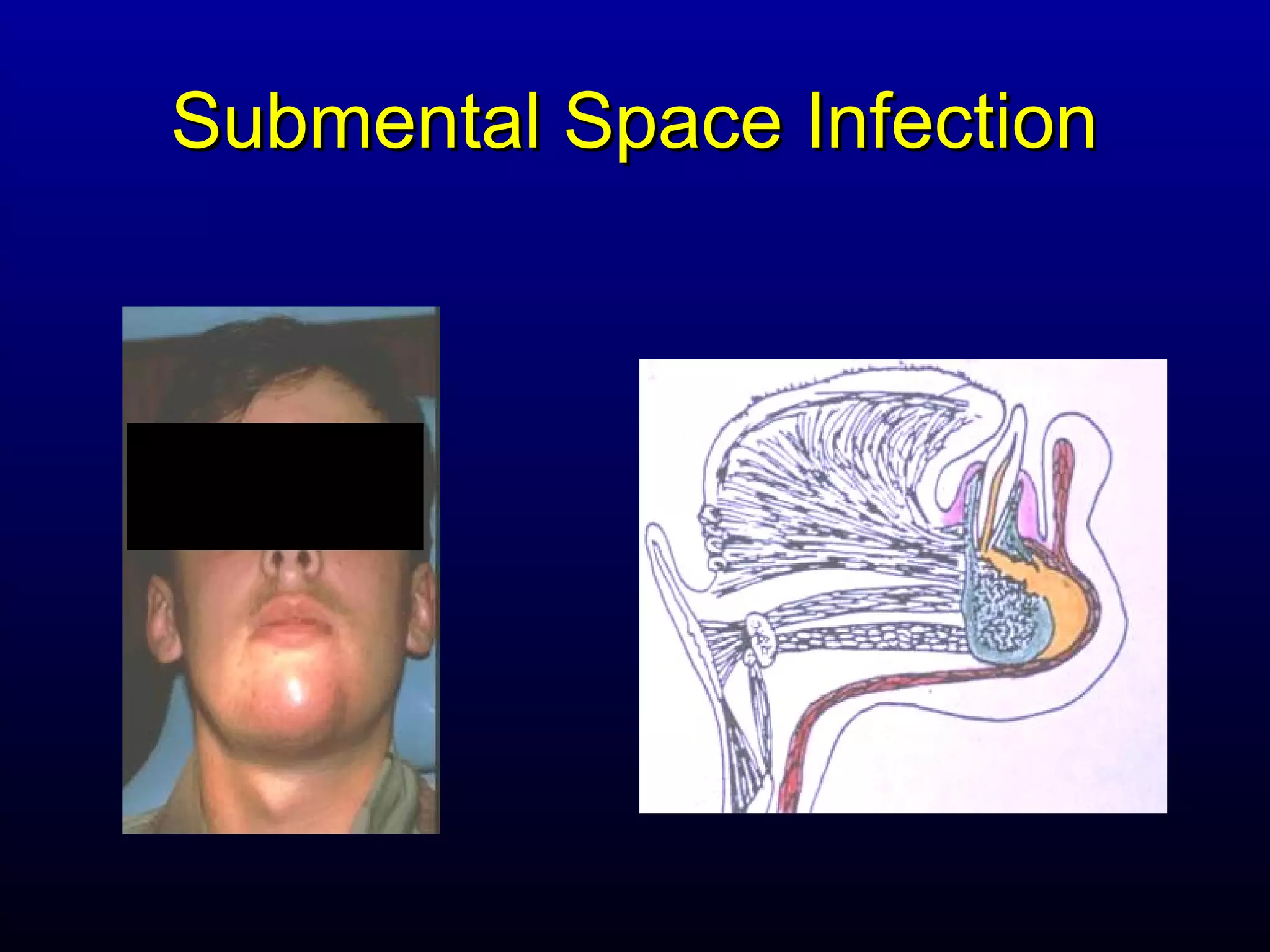 Odontogenic infections | PPT