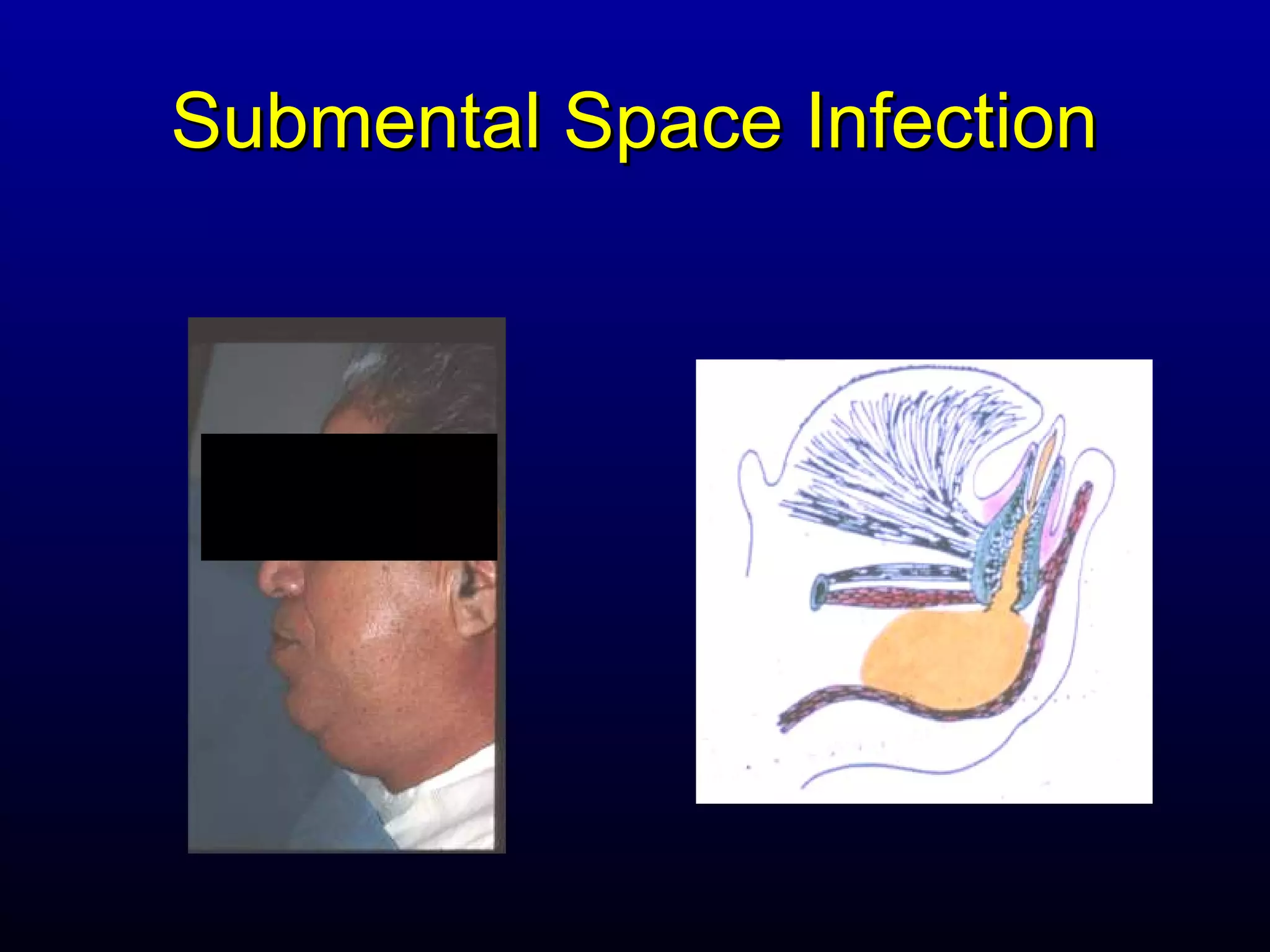 Odontogenic infections | PPT