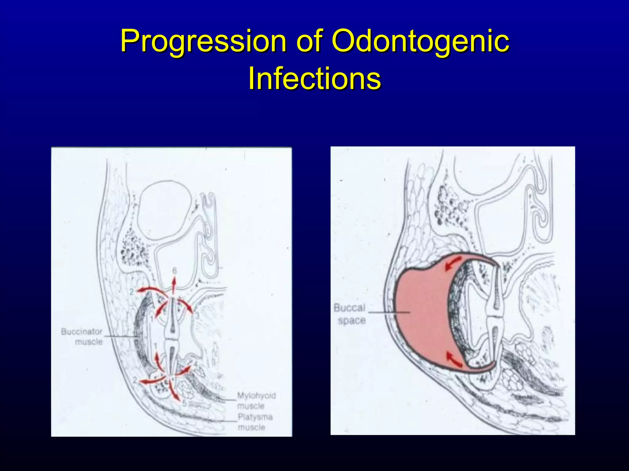 Odontogenic infections | PPT