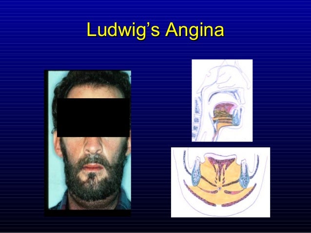 Odontogenic infections