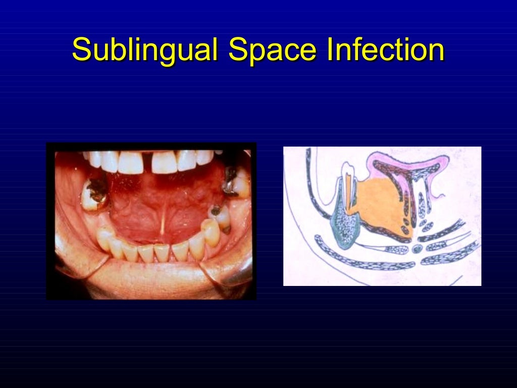 Odontogenic infections
