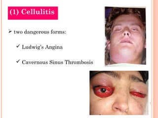 Cellulitis Dental