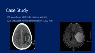 Odontogenic Infections & Spread 3100.pptx