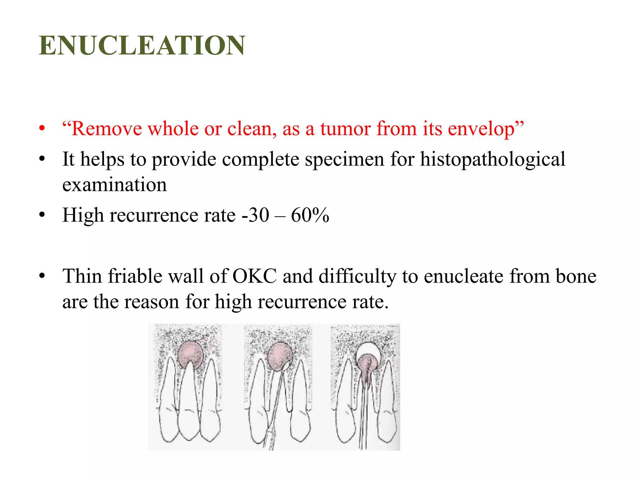 Odontogenic Keratocyst (OKC) | PDF