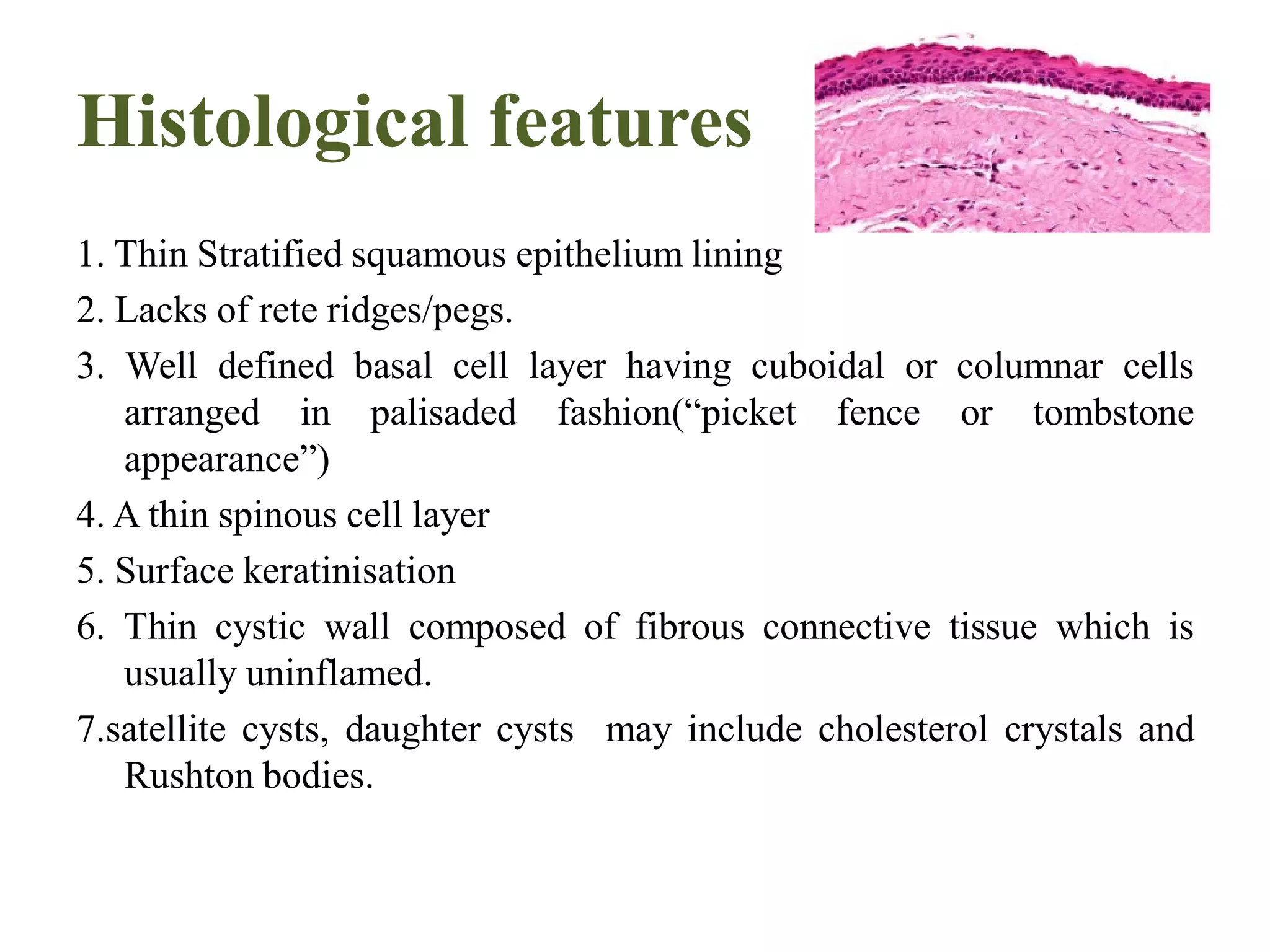 Odontogenic Keratocyst (OKC) | PDF