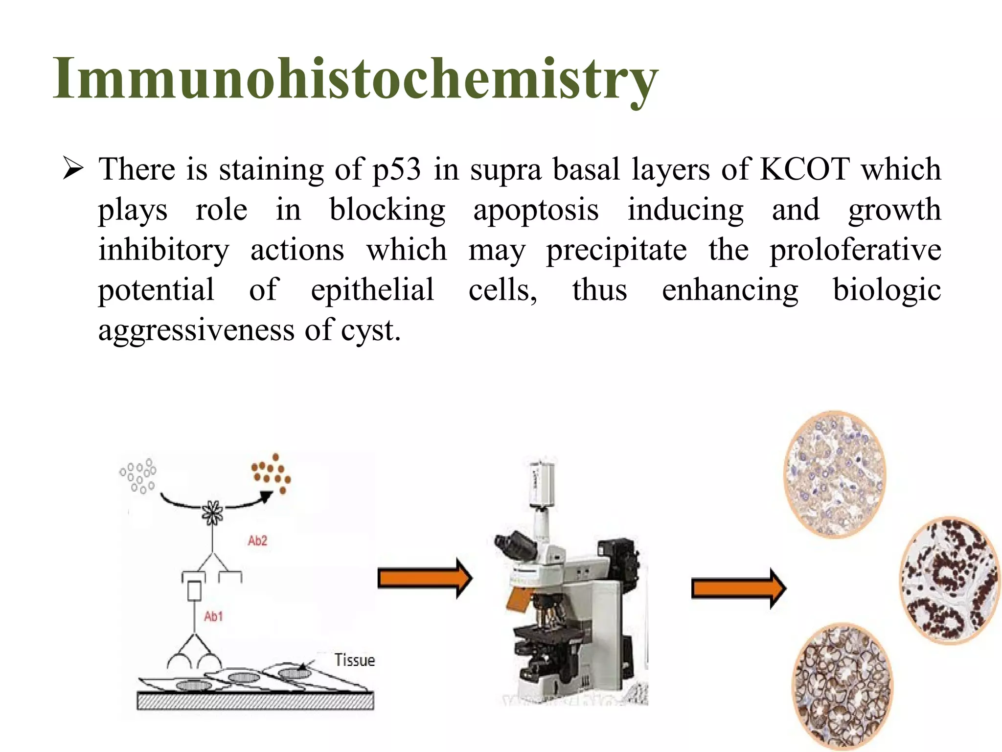 Odontogenic Keratocyst (OKC) | PDF