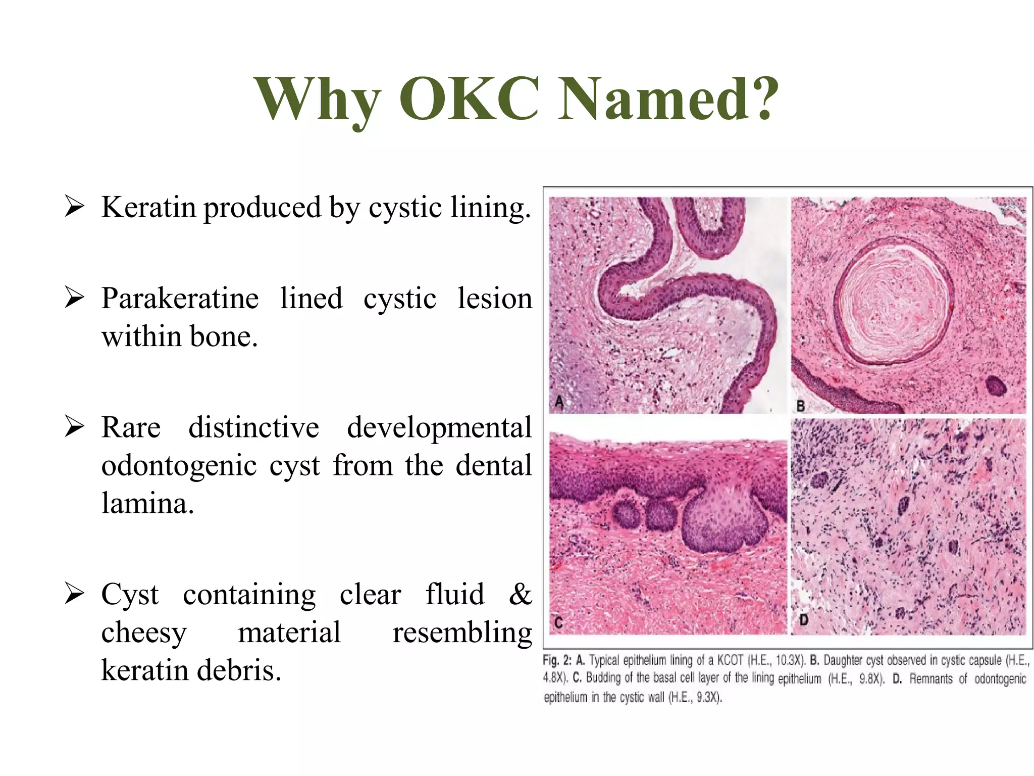 Odontogenic Keratocyst (OKC) | PDF