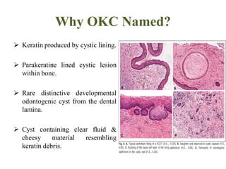 Odontogenic Keratocyst (OKC) | PPT