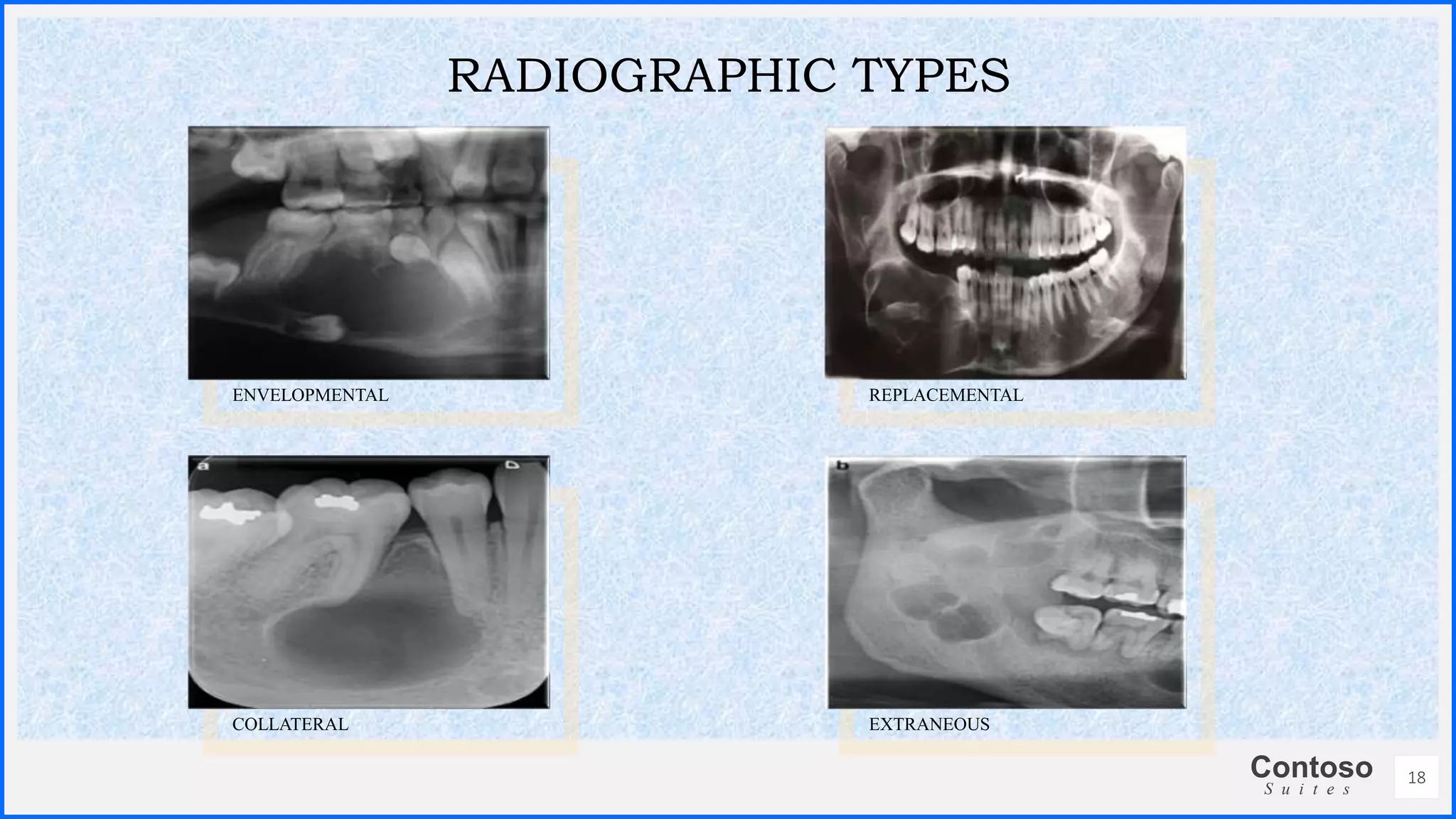 Odontogenic keratocyst | PPTX