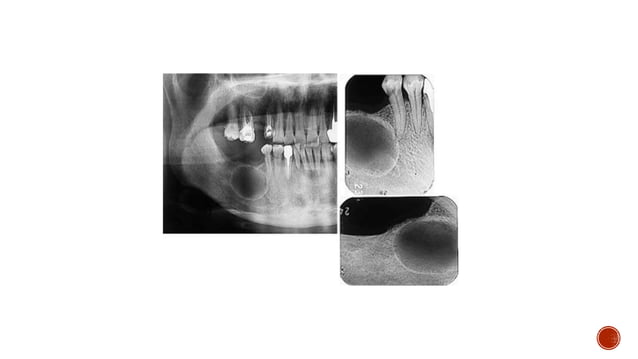 odontogenic keratocyst a developmental cyst | PPT