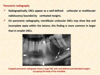Odontogenic Keratocyst: A Comprehensive Overview | PPTX