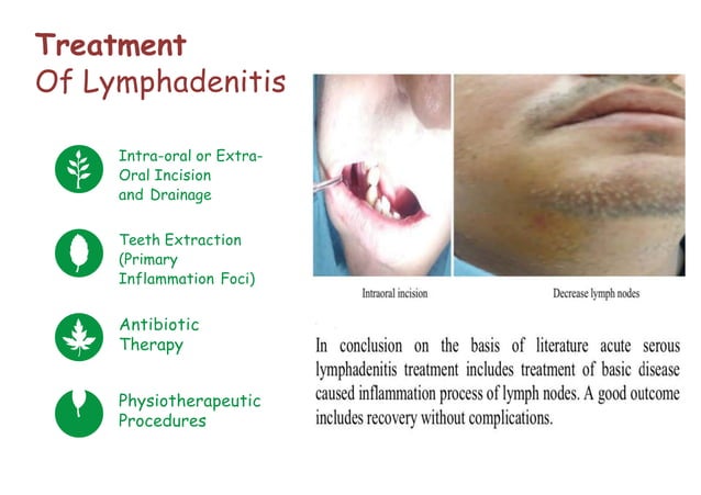 Odontogenic lymphadenitis and Adenophlegmon.pptx