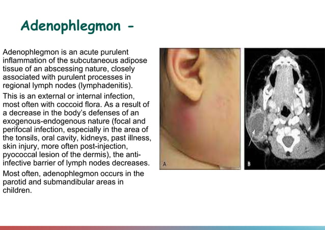 Odontogenic lymphadenitis and Adenophlegmon.pptx