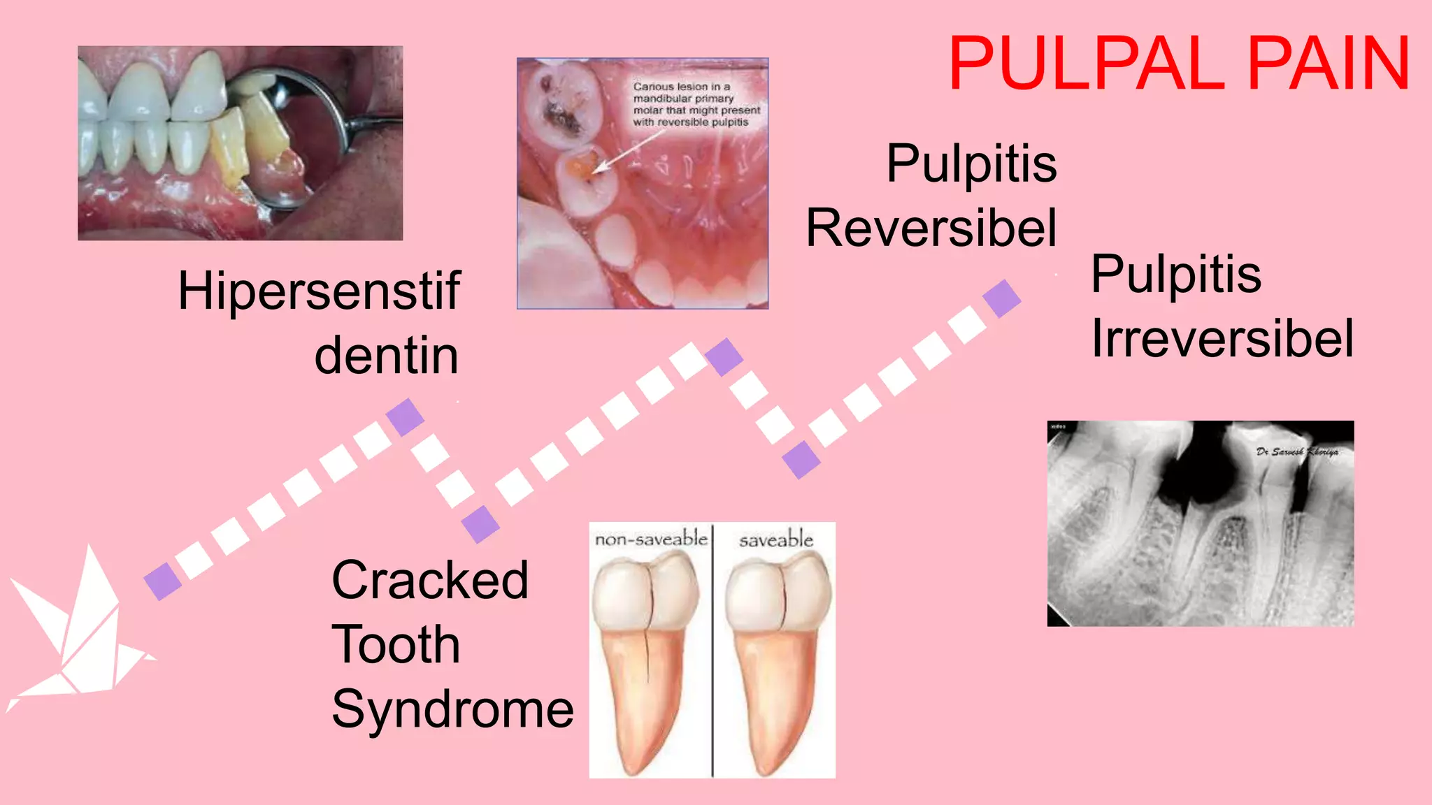 ODONTOGENIC PAIN DRG.NURLAELA TAHIR (1).pptx