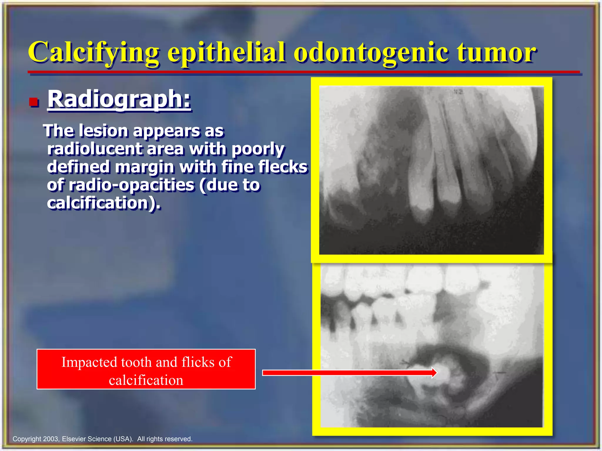 Odontogenic tumor | PPTX