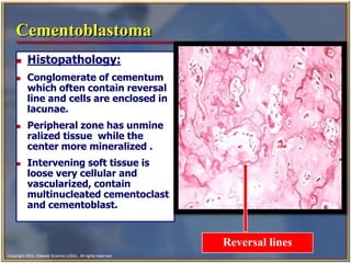 Cementoblastoma Histology