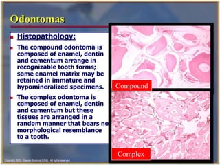 Complex Odontoma Histology