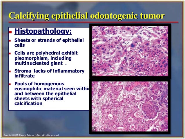 Calcifying Epithelial Odontogenic Cyst