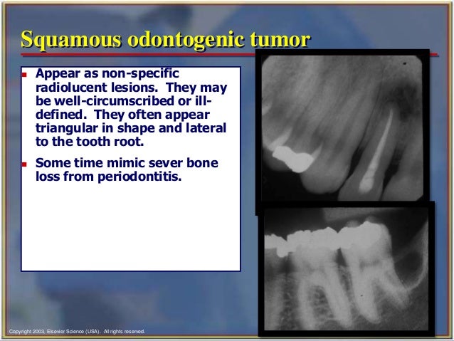 Odontogenic tumor